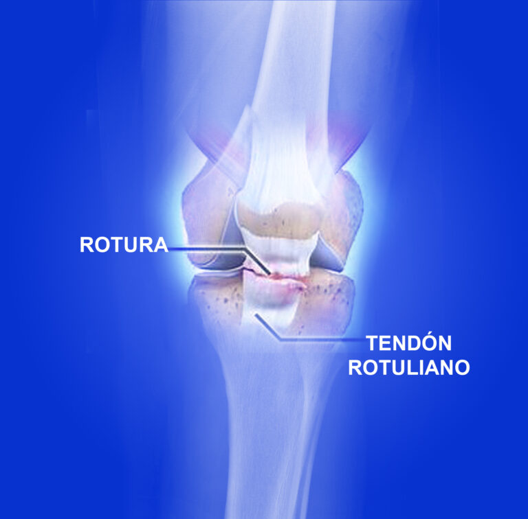 ROTURA DEL TENDÓN ROTULIANO: CAUSAS, PREVENCIÓN, TRATAMIENTO Y ...